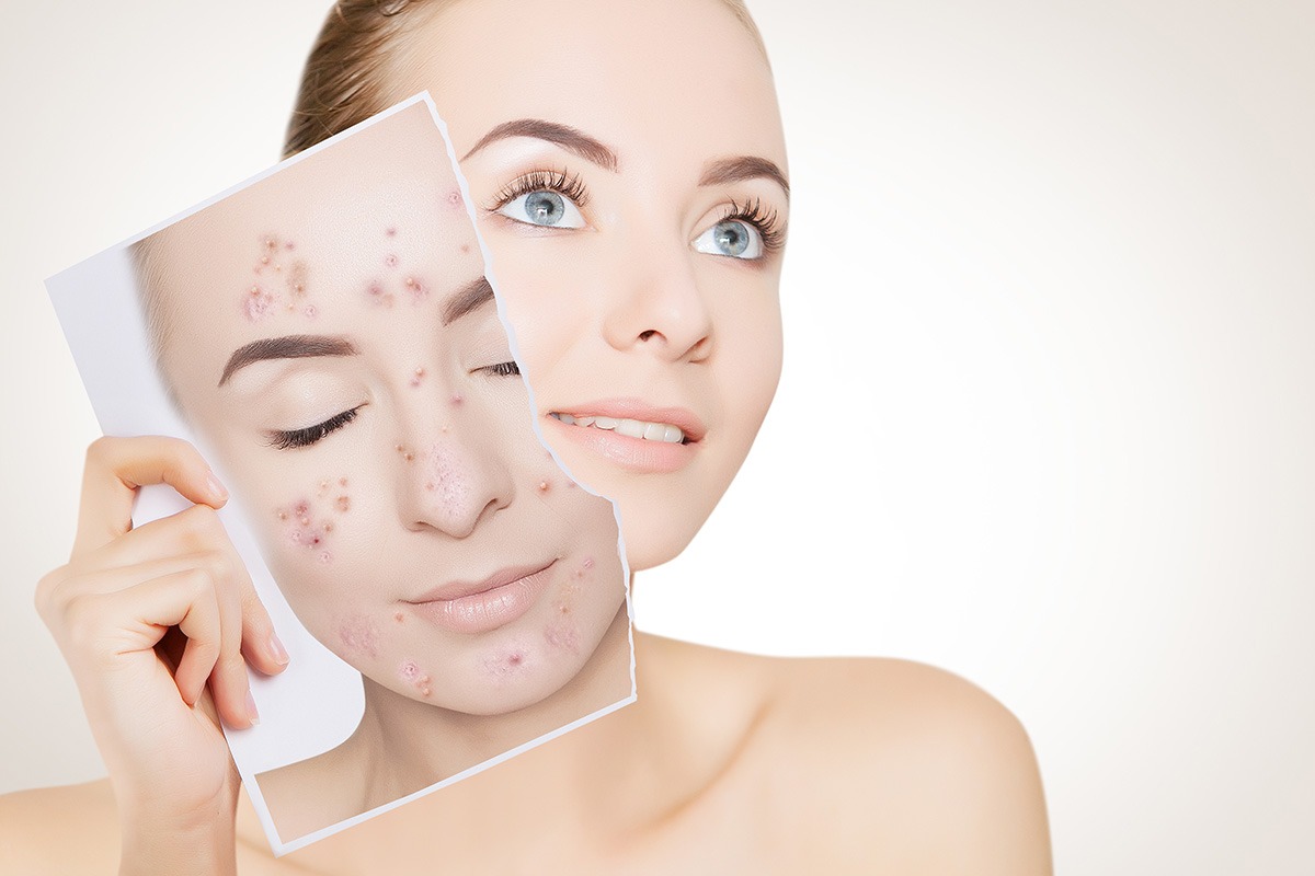 Manfaat Acne Treatment Facial bagi Kesehatan Kulit Berjerawat - RSa ...